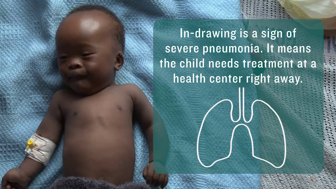 Signs of Pneumonia: Chest In-Drawing on Vimeo