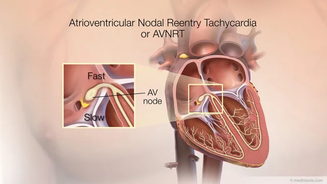 Av Nodal Reentrant Tachycardia