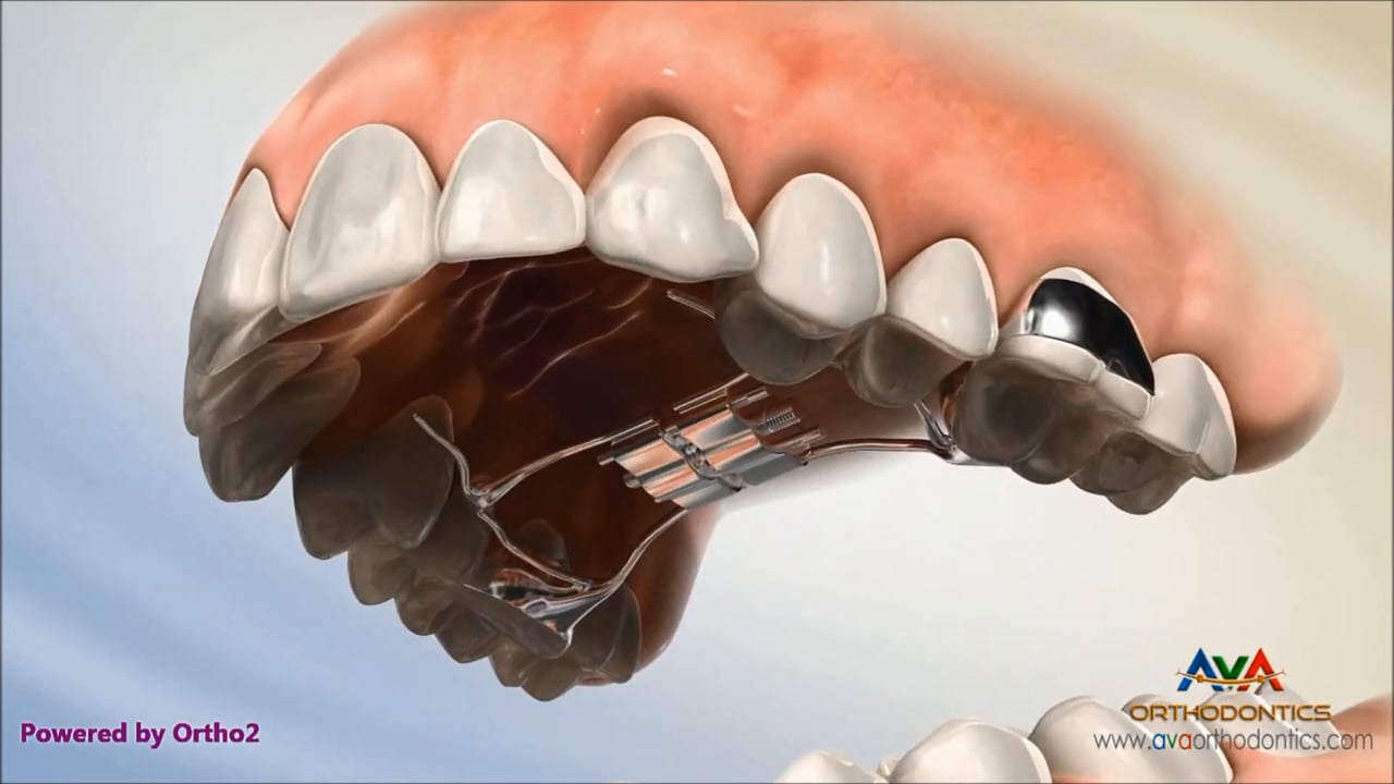 Palatal expander - HYRAX orthodontic device on Vimeo