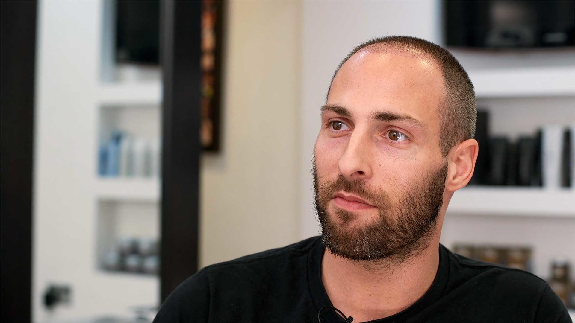 Theo's Hair Transplant Story on Vimeo