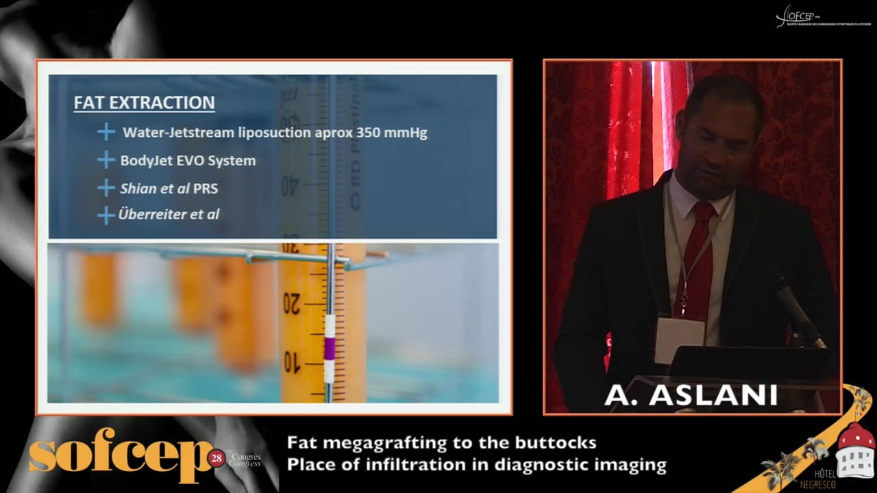 Dr. Alexander Aslani at the congress of the ISAPS, Nice 2015 on Vimeo