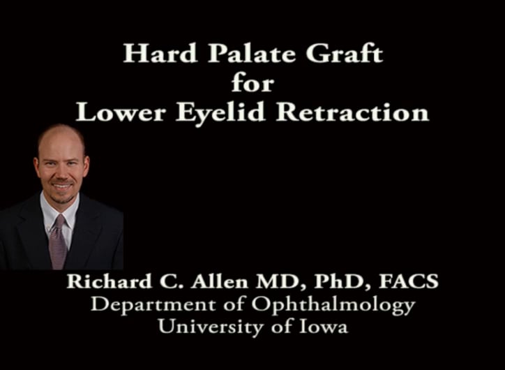 Hard Palate Graft for Lower Eyelid Retraction on Vimeo