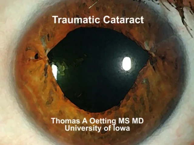 Traumatic Mydriasis