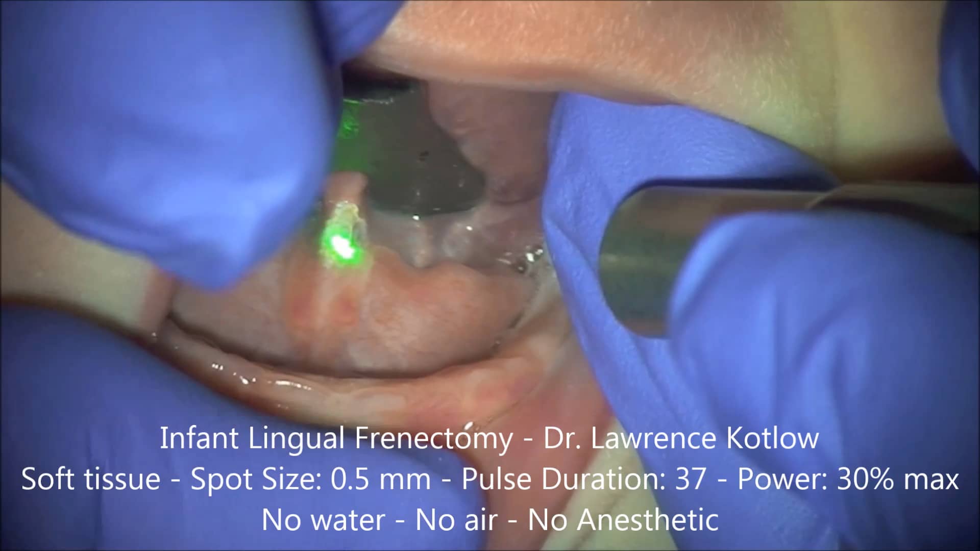 Frenectomy (Infant, lingual) - Kotlow, Lawrence (2015-06-10) on Vimeo