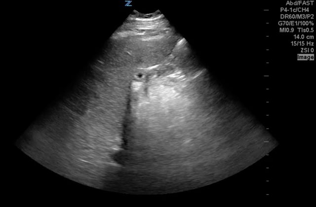 Gallbladder Ultrasound Transverse