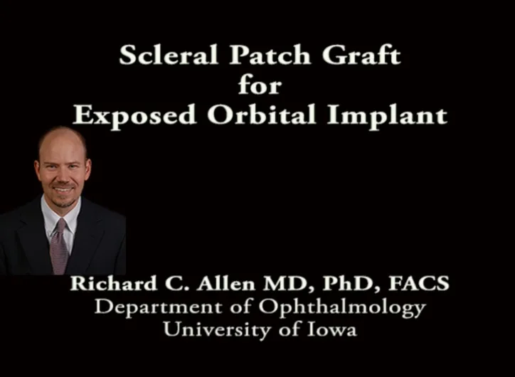 Scleral patch graft for exposed orbital implant on Vimeo