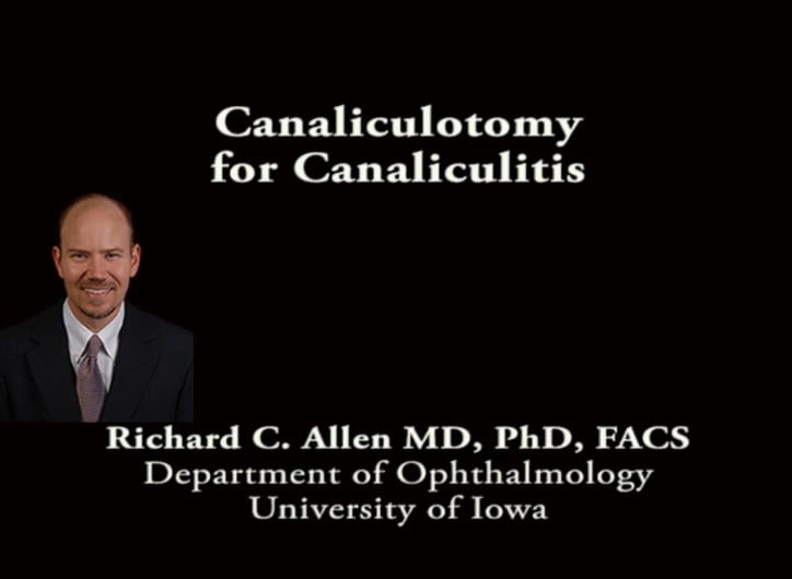 Canaliculotomy for canaliculitis on Vimeo