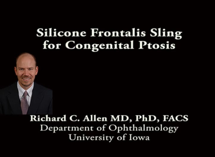 Silicone frontalis sling for congenital ptosis on Vimeo
