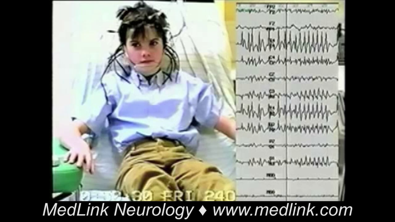 Focal clonic seizures | MedLink Neurology