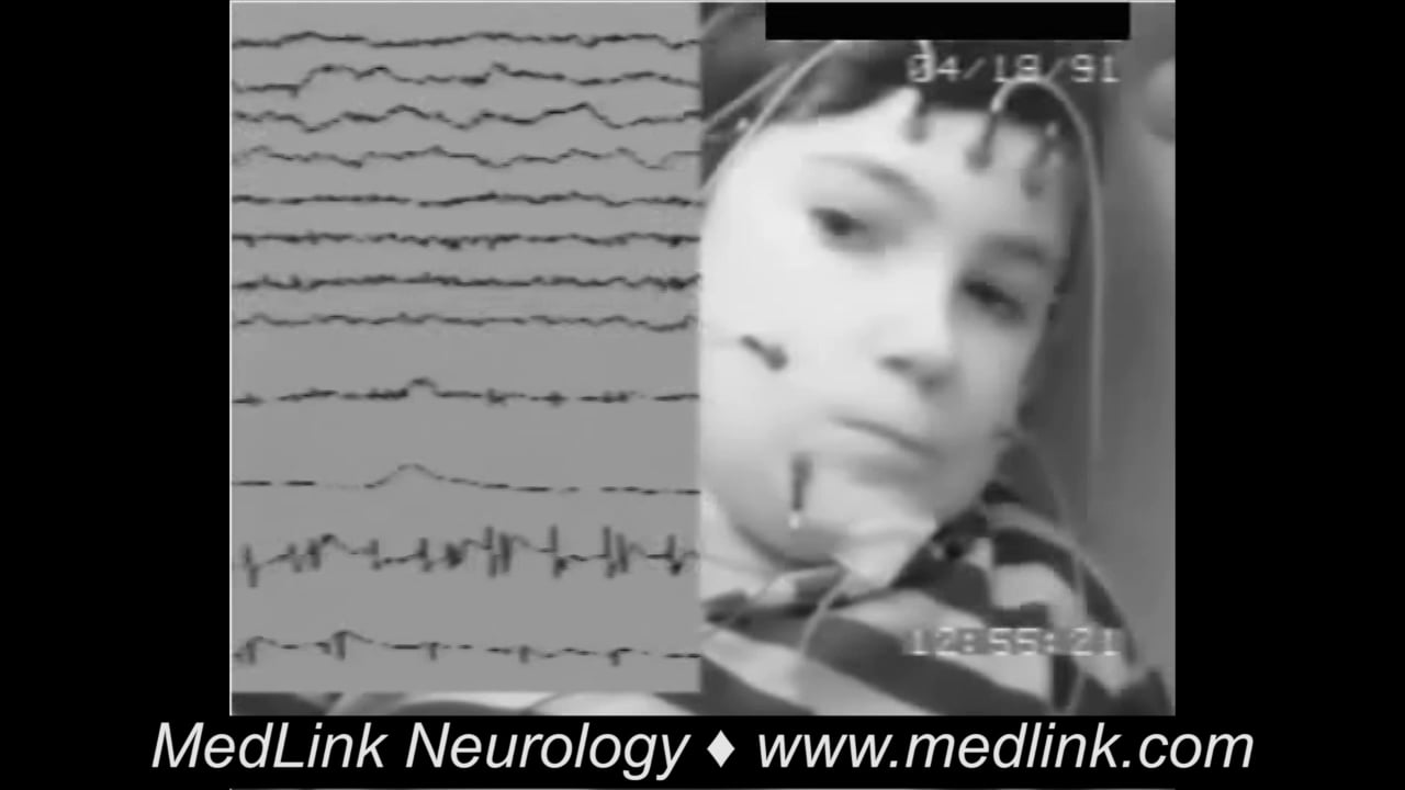 Focal clonic seizures | MedLink Neurology