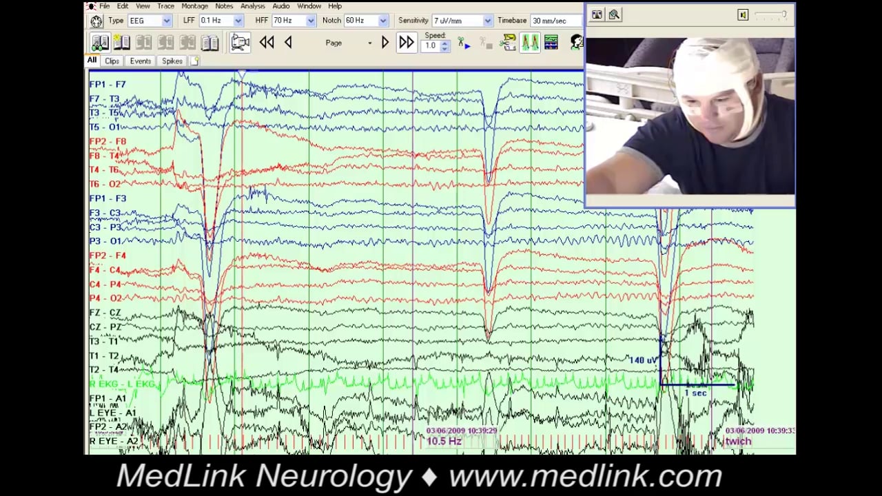 Ambiguous paroxysmal events | MedLink Neurology