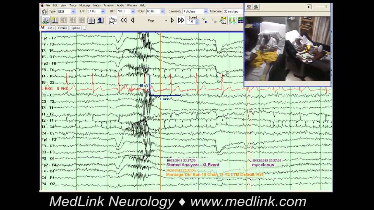 Ambiguous paroxysmal events | MedLink Neurology