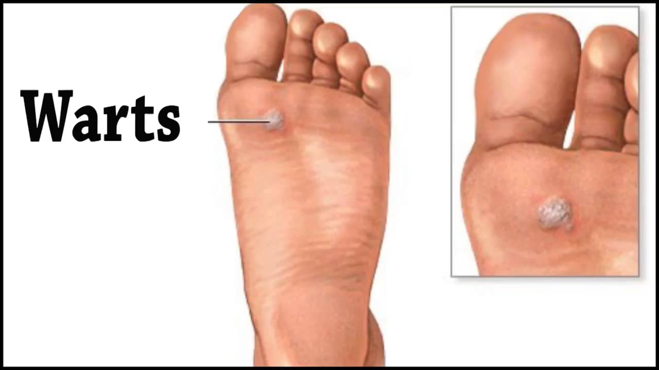 Foot Warts (Plantar Warts) - Podiatrist in Frisco, Texarkana and Ennis ...
