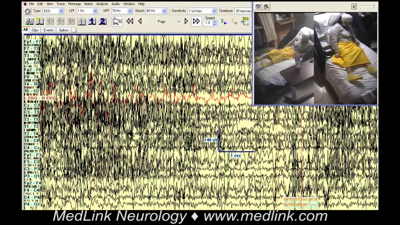Ambiguous paroxysmal events | MedLink Neurology