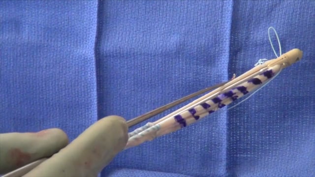 AperFix® II Tibial on Vimeo