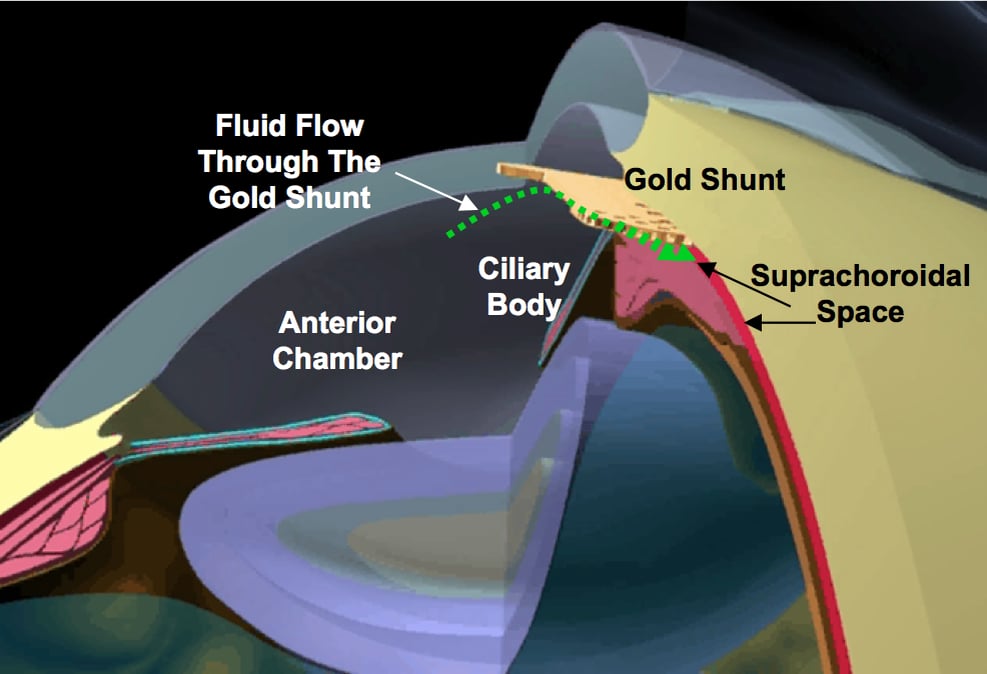 SOLX Gold Shunt Placement on Vimeo