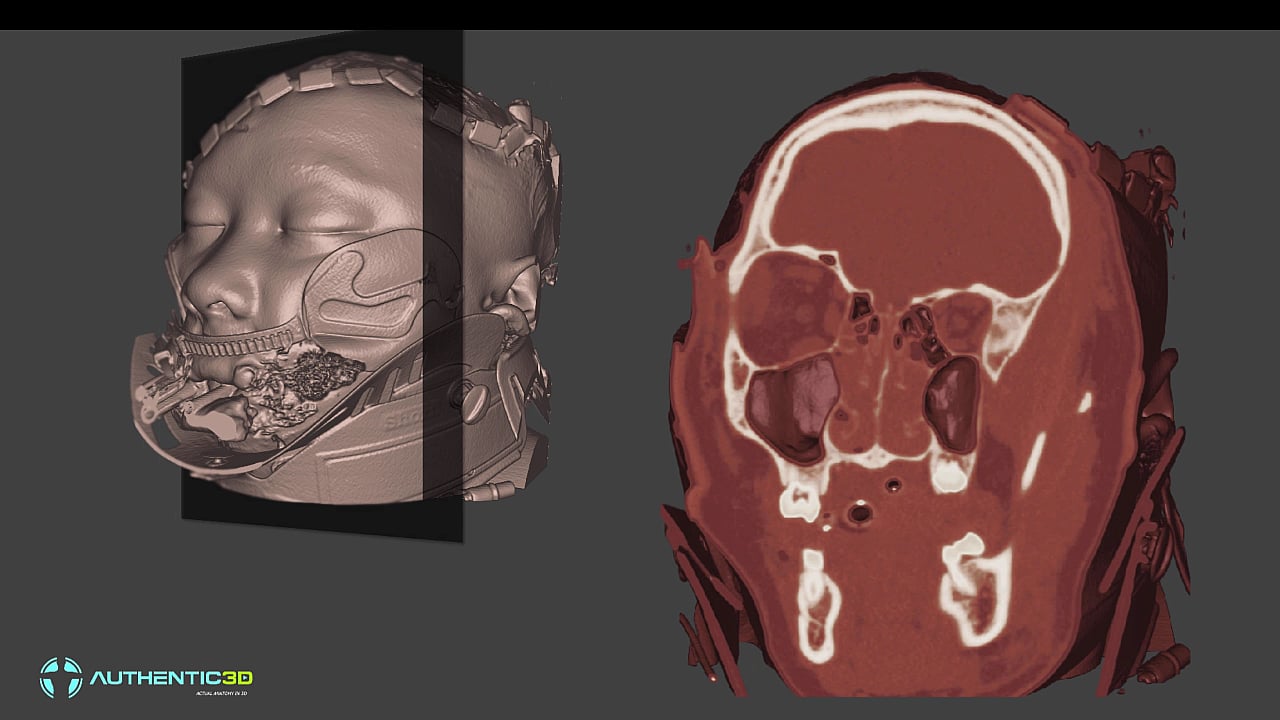 CT Head Scalp-Degloving DEMO on Vimeo