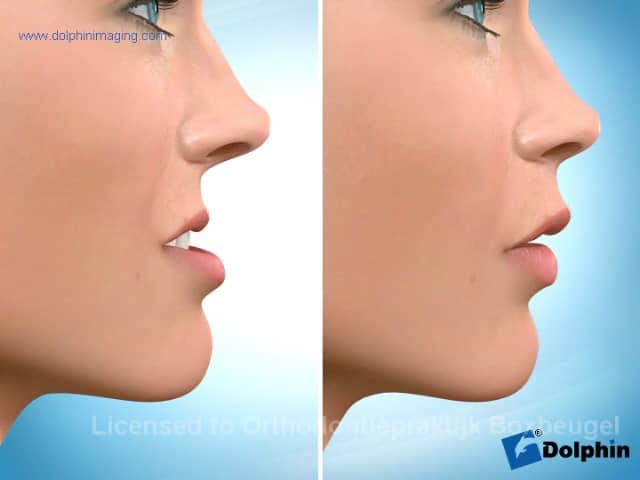 Maxillary Advancement Surgery on Vimeo