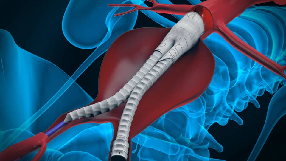 Anaconda™ - AAA stent graft system Vascutek on Vimeo