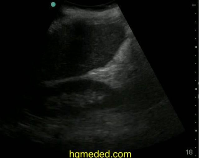 Ultrasonography - ascites on Vimeo