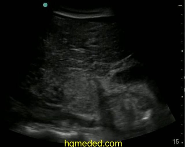 Ultrasonography - ascites on Vimeo