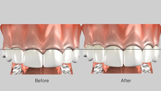 Crown Lengthening & Gum Lift in Framingham | Nobscot Dental
