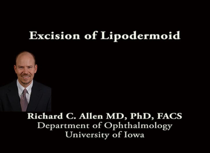 Excision of lipodermoid (dermolipoma) on Vimeo
