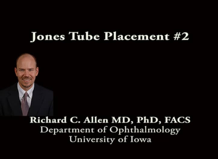 Jones tube placement #2 on Vimeo