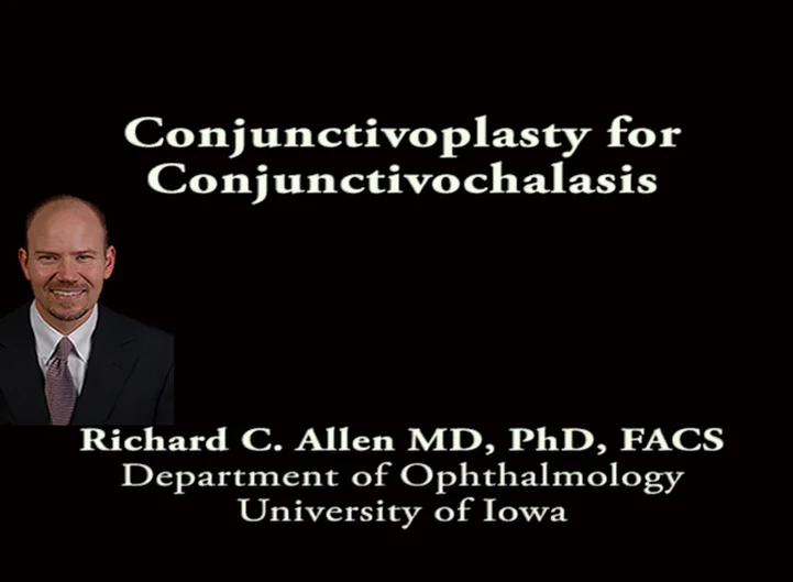 Conjunctivoplasty for conjunctivochalasis on Vimeo