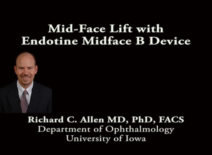 Mid-face lift with Endotine midface B device on Vimeo