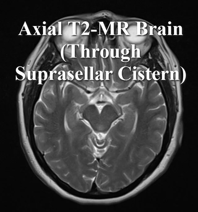 Suprasellar Cistern Anatomy