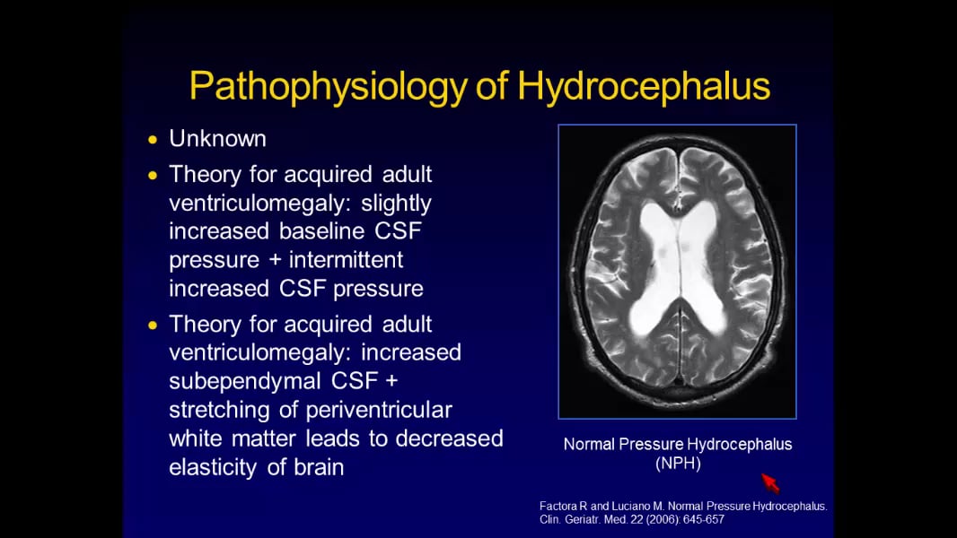 Neurocurriculum Live: Imaging of Hydrocephalus: Pathophysiology