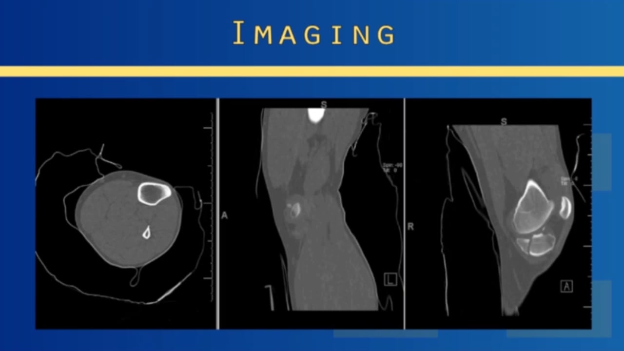 ORIF of a posteromedial tibial plateau fracture through the Lobenhoffer ...