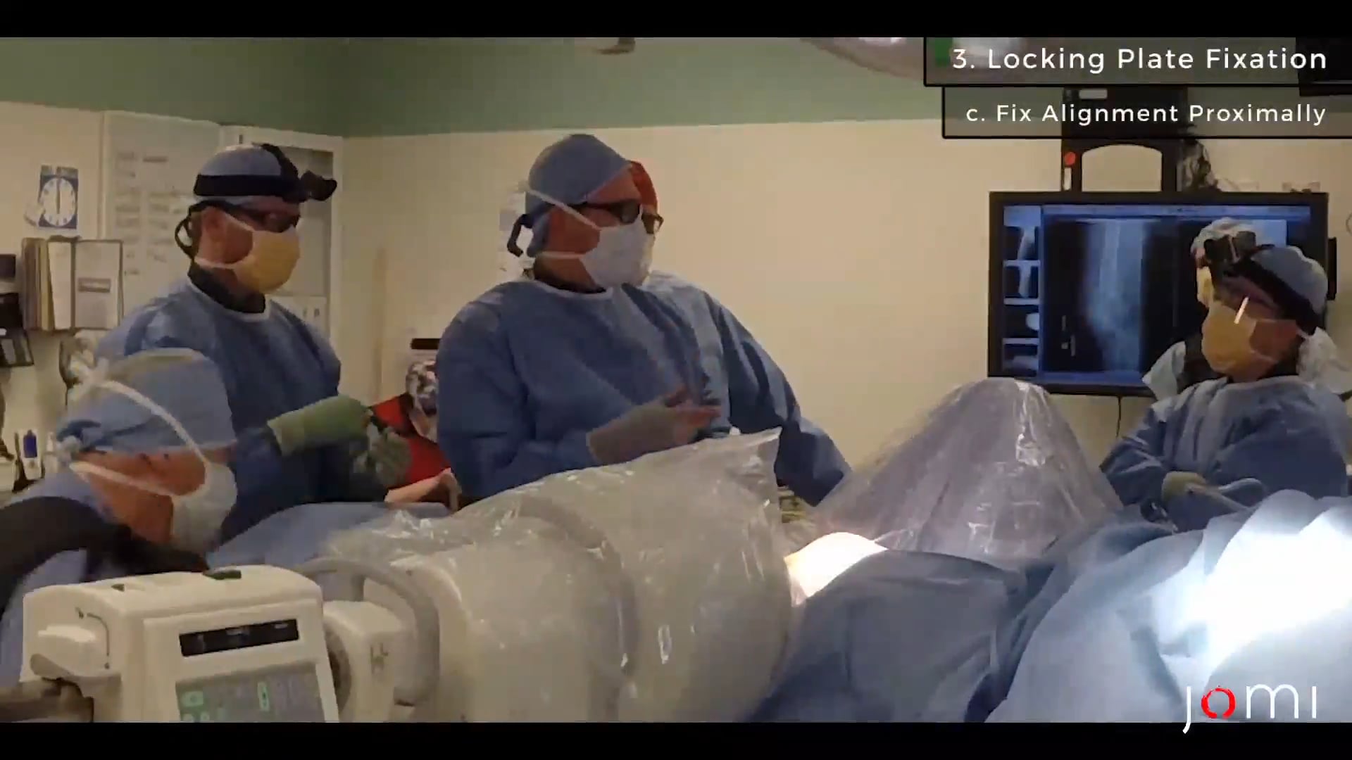 OTA Video Library - LISS System for stabilisation of a distal femur ...