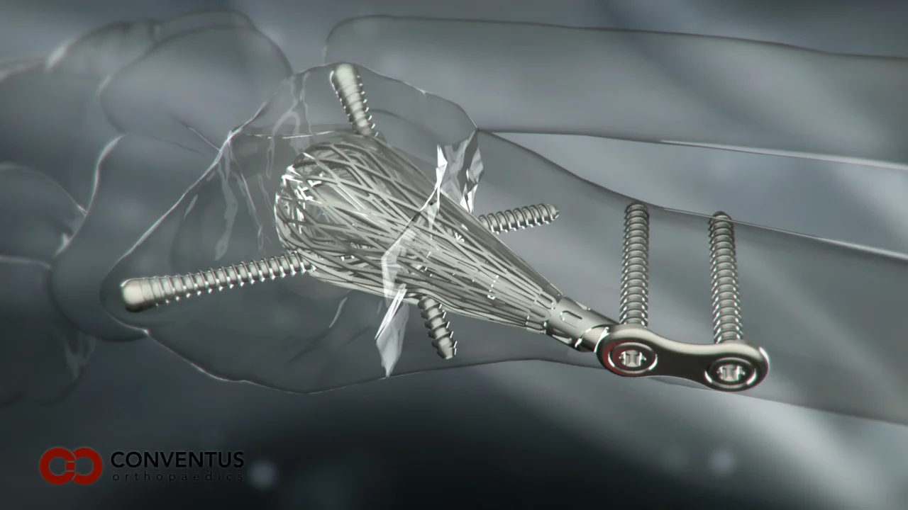 Conventus Orthopedics Distal Radius System Animation on Vimeo