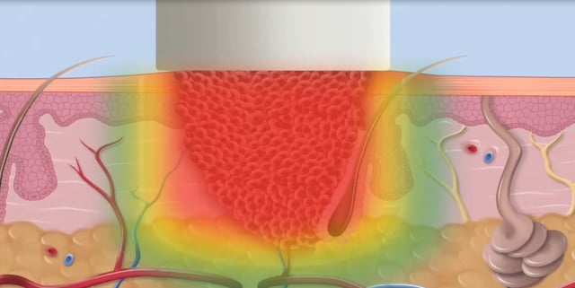 Plantar Wart Root Diagram