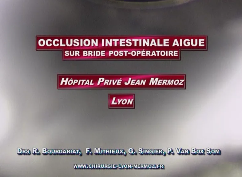 Coelioscopie exploratrice - Occlusion du grêle sur bride on Vimeo