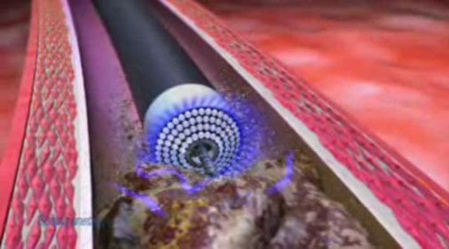 Spectranetics' Excimer Laser Ablation on Vimeo