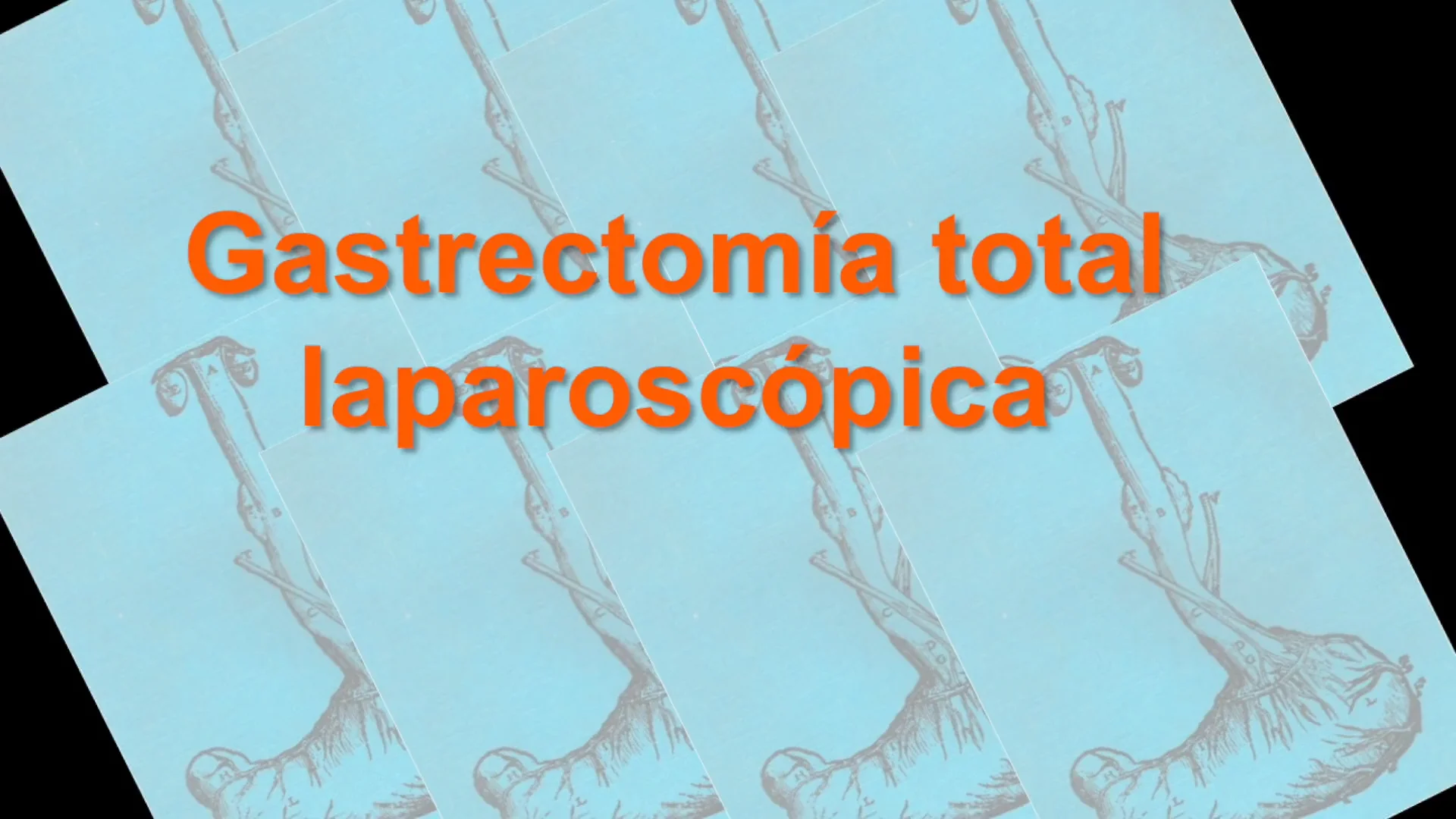 Gastrectomía total laparoscópica (Aula Cirugía Laparoscópica Hospital ...