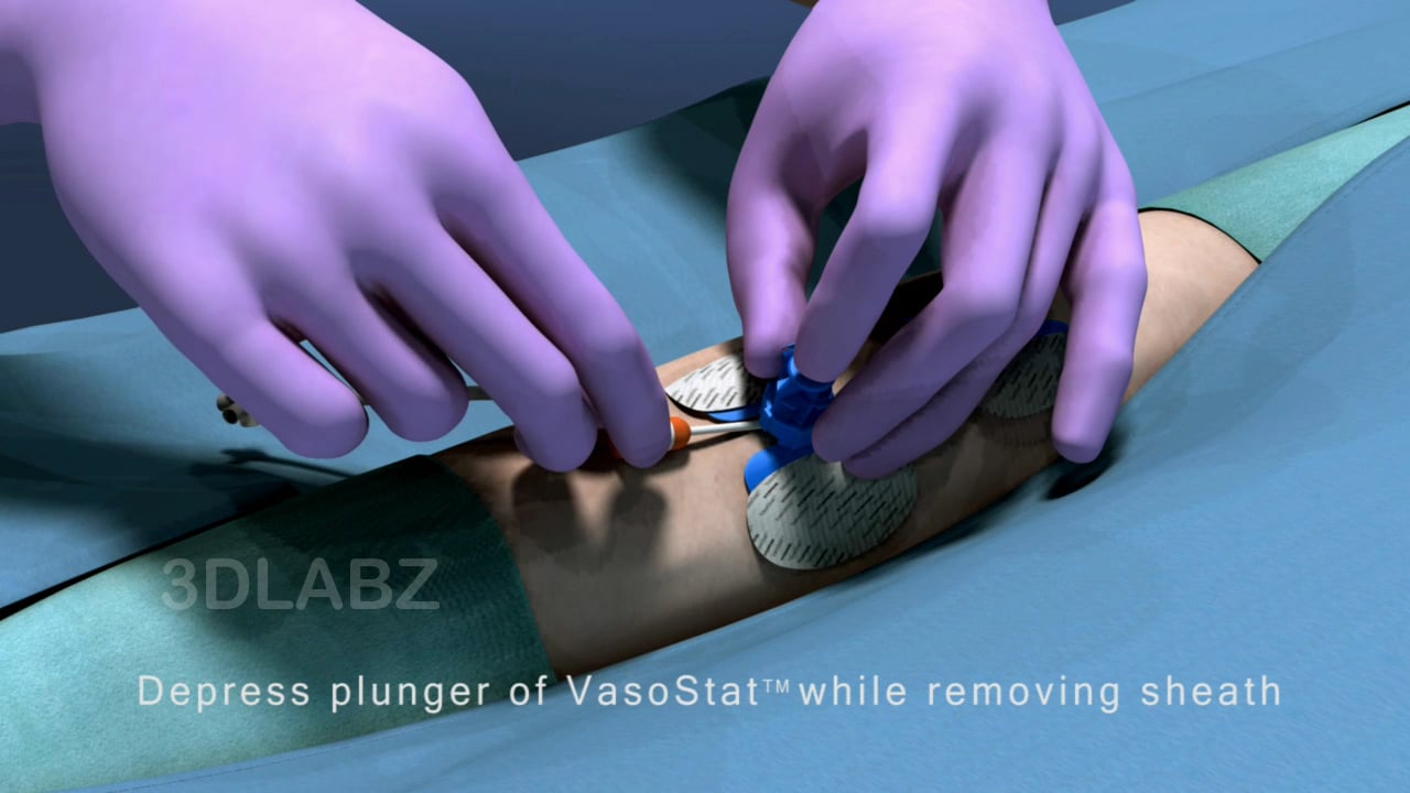 Hemostasis Device used in Dialysis access interventions | Medical ...