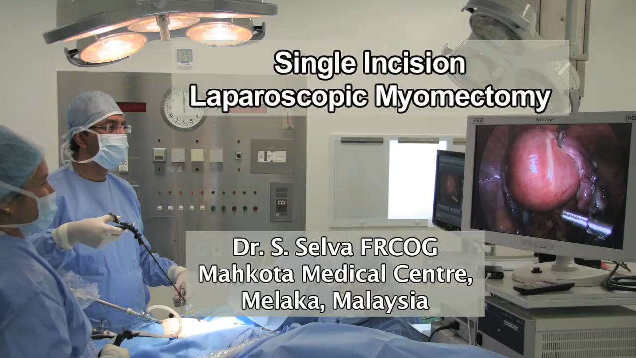 Video 19.7 single incision laparoscopic myomectomy on Vimeo