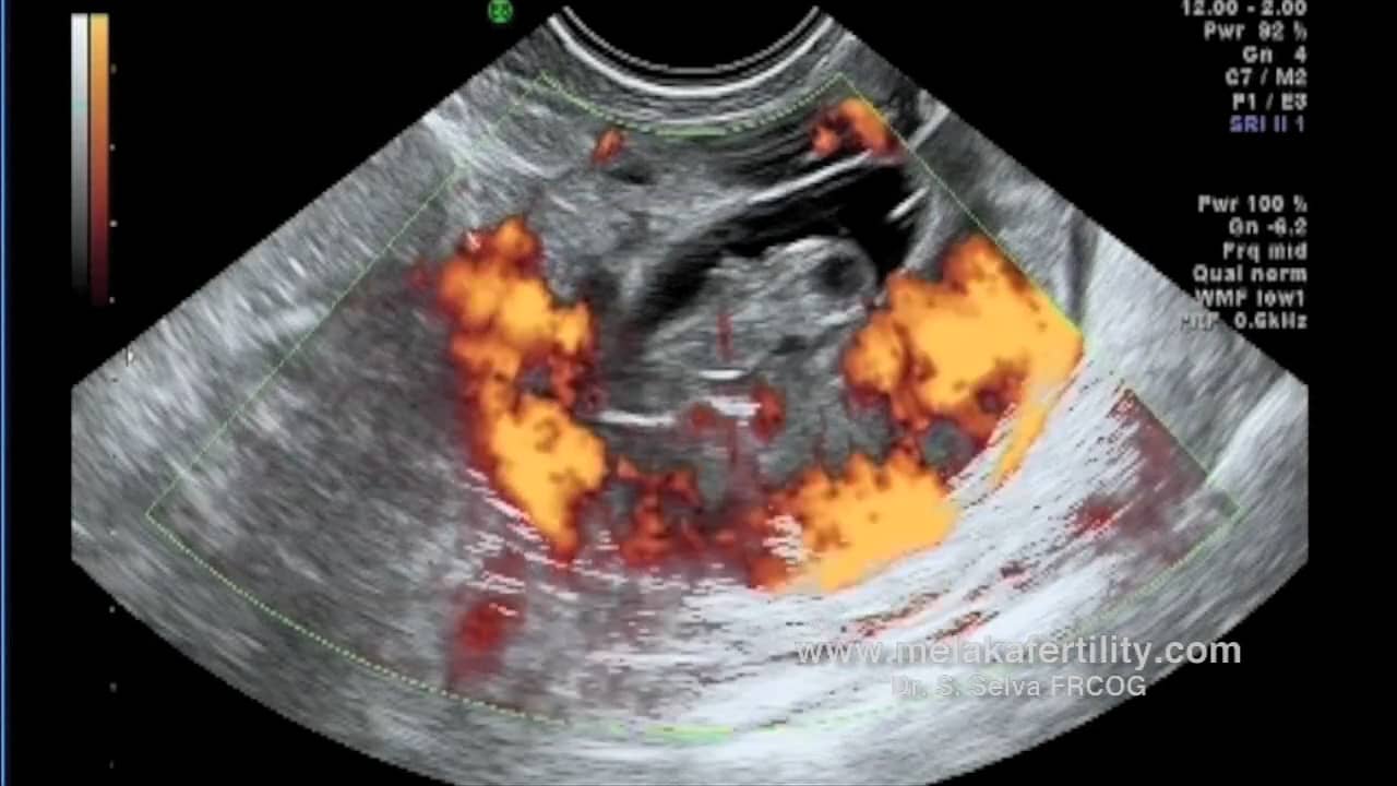 Video 26.1 laparoscopic salpingectomy for ectopic pregnancy on Vimeo