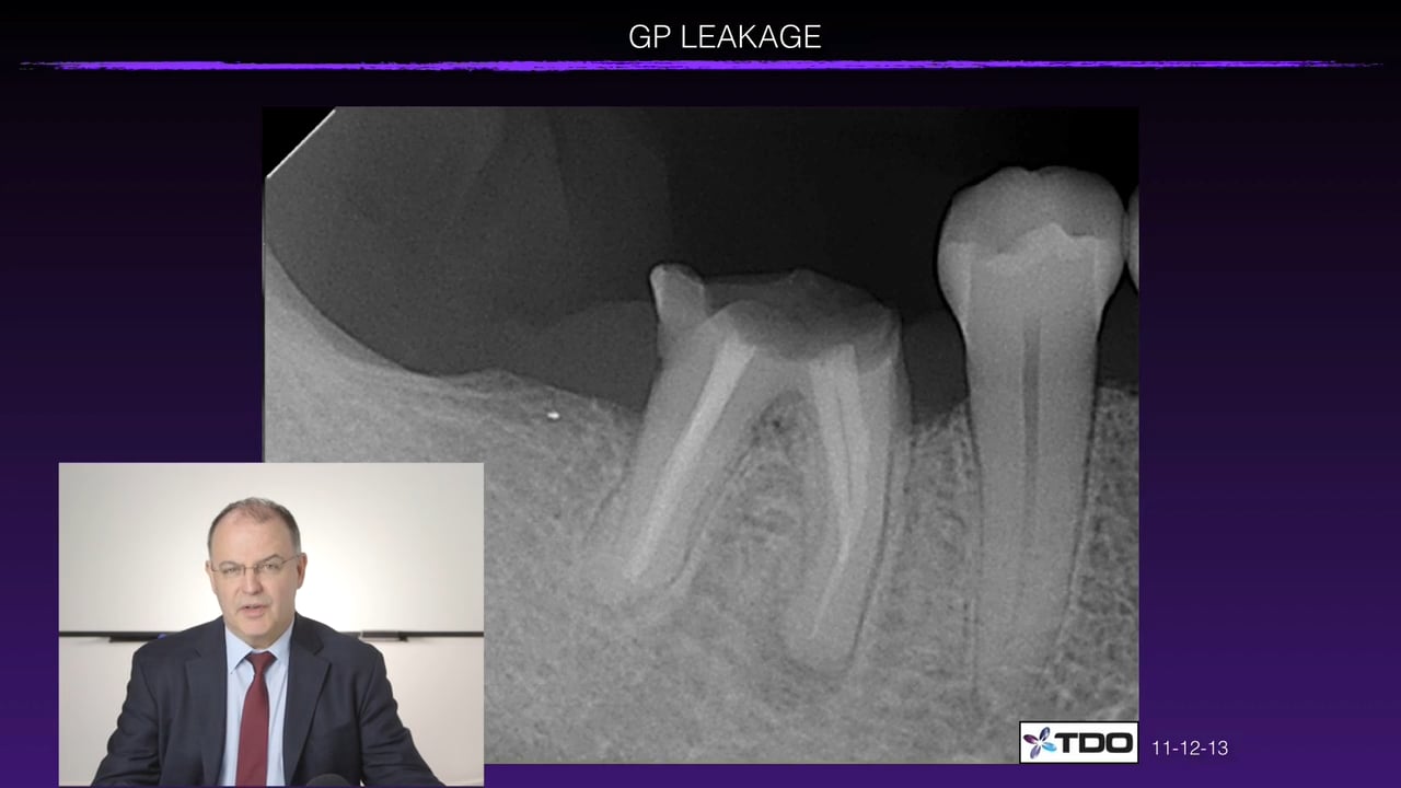 Reduced Coronal Leakage with Bonded Obturation?! (Dr. Alex Fleury ...