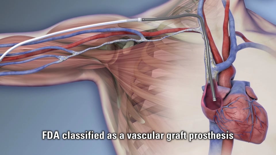 HeRO® Graft - Implant Overview Animation in HeRO Graft on Vimeo