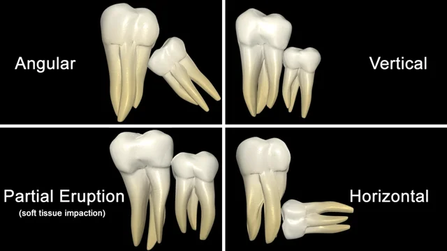 Wisdom Teeth Partial Eruption