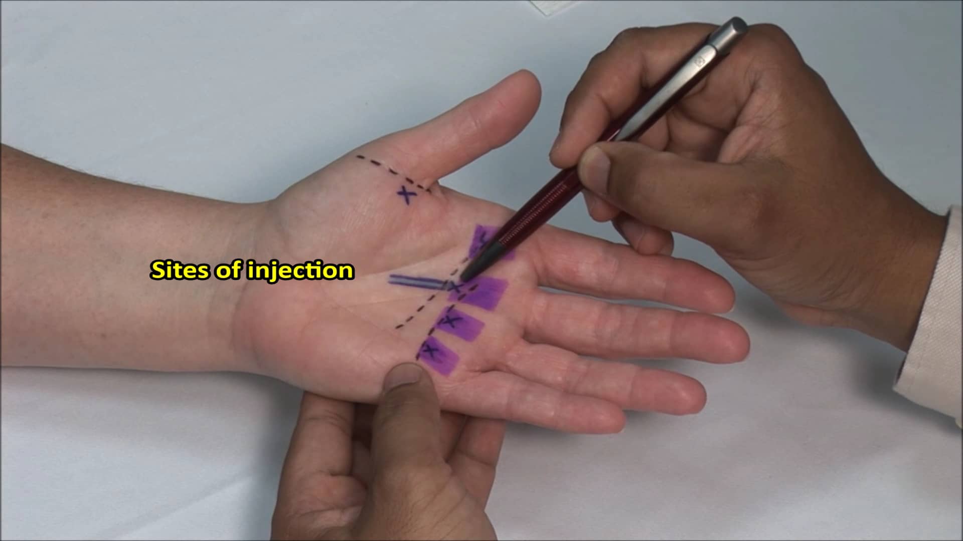 Flexor Tendonitis (Hand) Injection on Vimeo