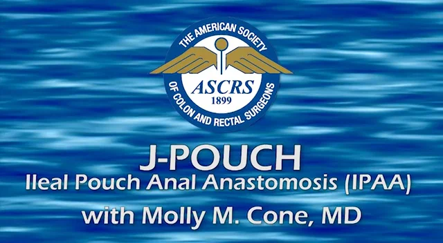 Colonic J Pouch Anastomosis