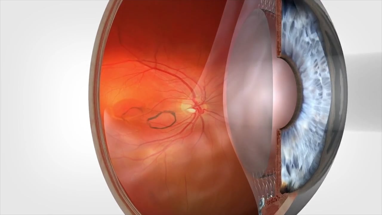 Miodesopsie Mosche Volanti on Vimeo