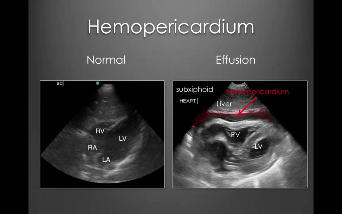 Slide 21 - hemopericardium on Vimeo