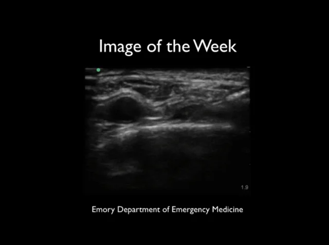 Superficial Peroneal Nerve Block